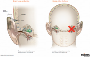 Bone Anchored Hearing Aids | Tampa Bay Hearing and Balance Center